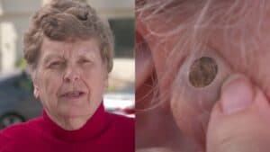 Ontario woman finally gets 55-year-old blackhead removed on TLC's 'Dr. Pimple Popper' after ...