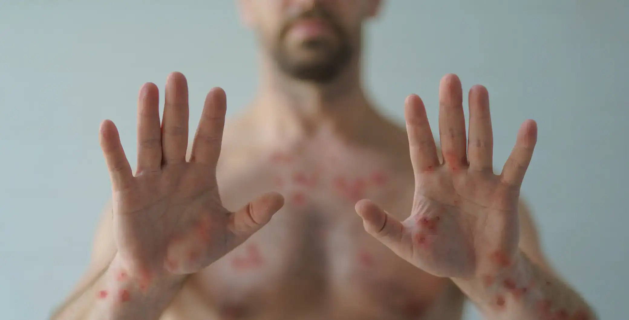 Toronto seeing rise in monkeypox cases; officials urging residents to ...